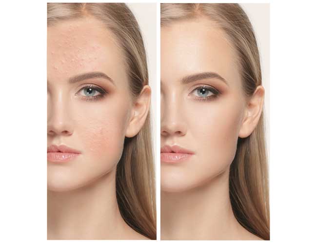 మచ్చల్ని దాచేసే ‘శాండ్‌విచ్‌ మేకప్‌’ | all-you-need-to-know-about ...