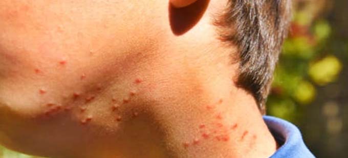 Scrub Typhus: చిన్నారులకు కొత్త రకం వ్యాధి.. యూపీలో 8 మంది మృతి | scrub ...