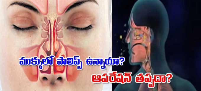 Health: ముక్కులో పాలిప్స్‌ ఉంటే ఆపరేషన్‌ తప్పదు | nasal-polyps-and ...